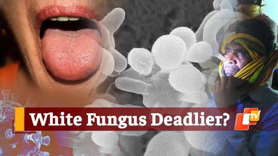 After Mucormycosis, Concerns Raised Over White Fungus Infection