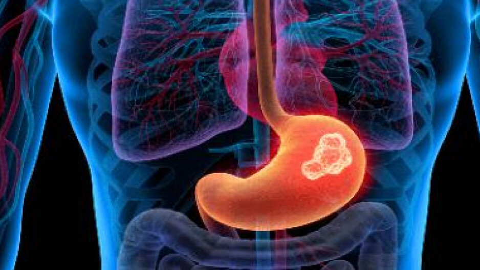 New method to detect ulcer, gastric cancer-causing bacteria