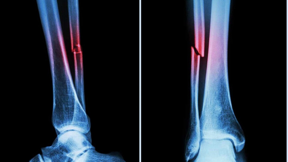 New machine algorithm can identify heart, fracture risks with routine ...