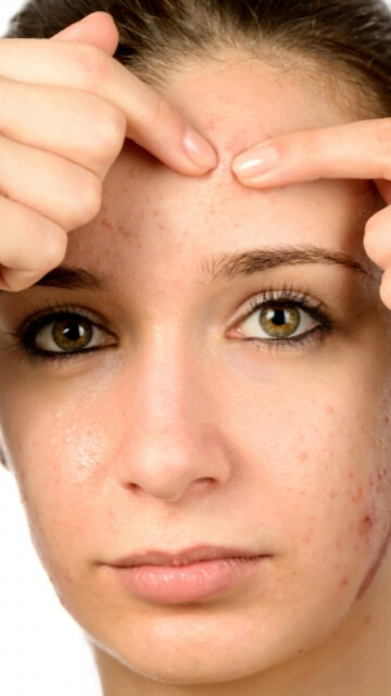 5 Fast Methods For Pimple Removal